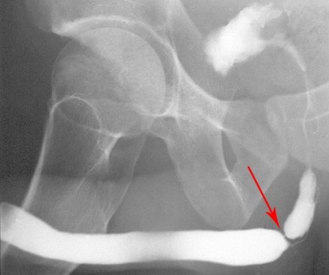 Urethral Stenosis - Centro di Chirurgia Ricostruttiva Genito-Uretrale